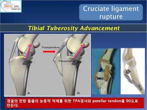 Ttatibial Tuberosity Advancement 시스템 Youtube