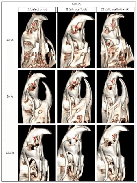 Image Of The Cranial Bone Defect Reconstructed Three Dimensionally