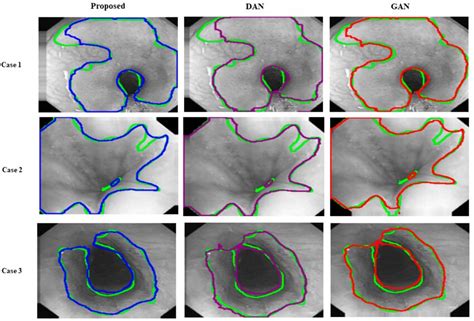Visual Samples Of The Segmentation Performance Of Semi Supervised