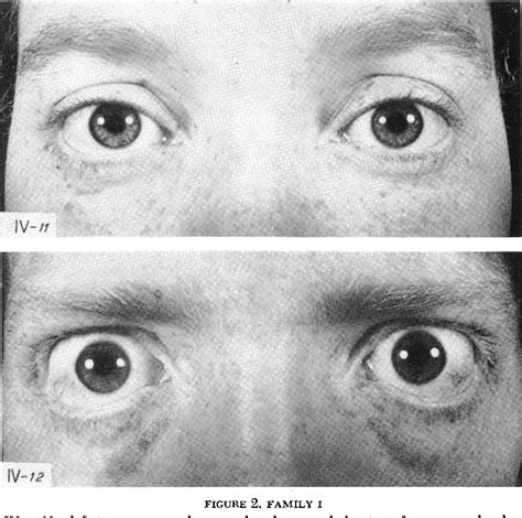 Figure 2 From A New Syndrome Combining Pterygium Colli With