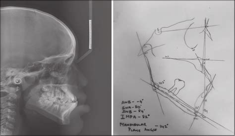 A Lateral Cephalogram B Linear And Angular Analysis On The Cephalogram Download