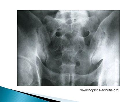 Ppt Enteropathic Arthritis Powerpoint Presentation Free Download Id3317106