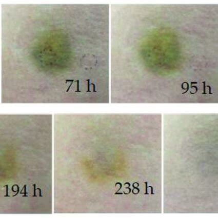 Chronological Evolution Of Bruise 1 The Arrow Indicates The Circular