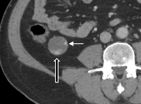 Axial Contrast Enhanced Ct Image Obtained At The Nephrographic Phase In