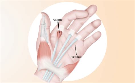 Trigger Finger Hand Exercises Physiotherapy Curezone Physiotherapy