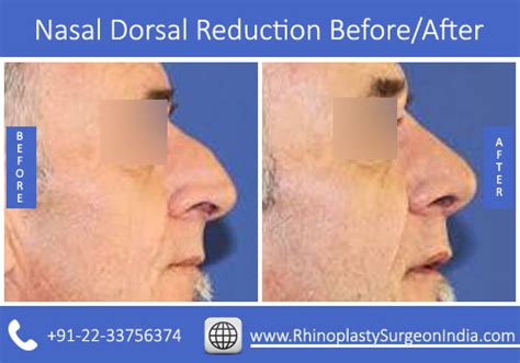 Nasal Dorsal Reduction Rhinoplasty Surgeon India