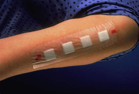 Arm Patch Tests To Determine Allergen Sensitivity Photograph By Mike Devlin Science Photo Library