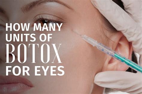 How Many Units Of Botox For Eyes Fitness Beauty Art