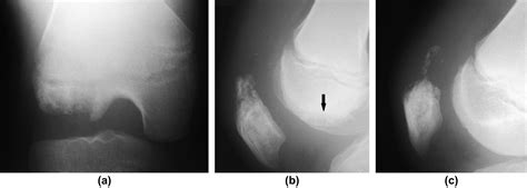 Bilateral Osteochondrosis Of The Superior Pole Of The Patellae In