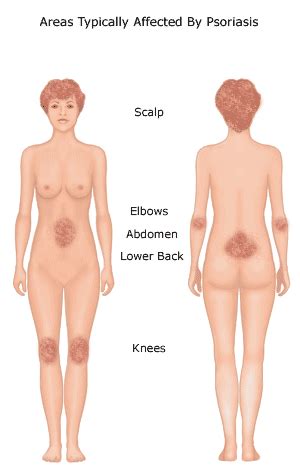 PSORIARIS DAATC