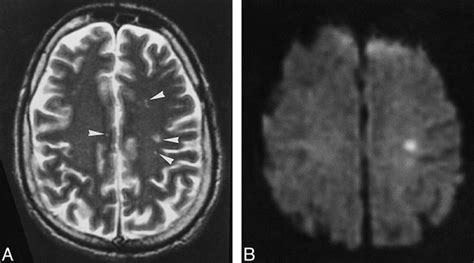 Encephalitis