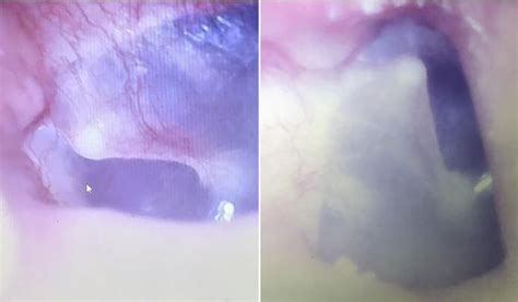 The Difference Between A Normal Eardrum And A V2k Eardrum Picture 1