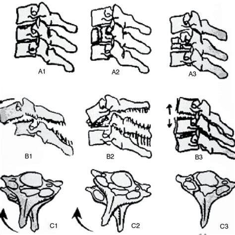 Ao Classification Of The Fractures In Operated Patients Download