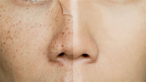 Diferencias Entre Las Manchas De La Piel Cuáles Son Y Los Tratamientos