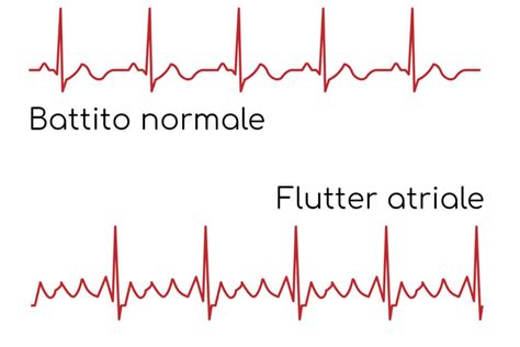 Flutter Atriale Sintomi Diagnosi Ed Ecg Terapia