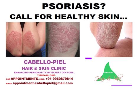 Psoriasis Is Treated Here At Cabello Piel Hair And Skin Clinic