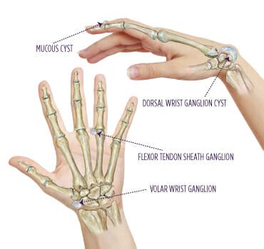 Flexor Tendon Sheath Ganglion Cyst Symptoms