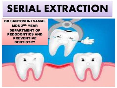 Dewel`s Method Of Serial Extraction Interceptive Orthodontics Pptx