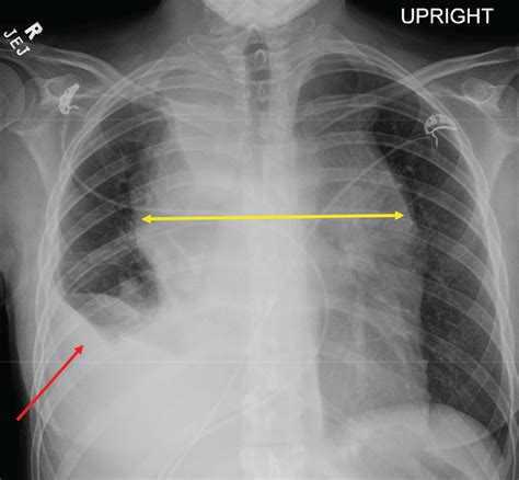 Chest X Ray Pleural Effusion Interpretation Optimizing Adult Oriented