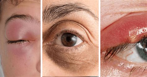 كيفية علاج تورم العين