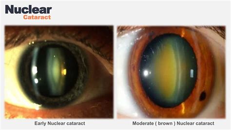 Cataract Slide Pptx