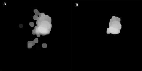 Brain Tumor Segmentation Using Morphological Processing And The Discrete Wavelet Transform