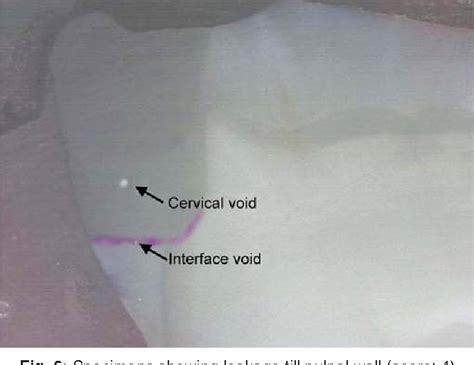 Flowable Composite Lining At Brianna Hort Blog