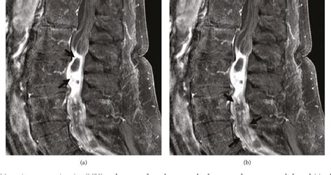 Figure 1 From Intradural Staphylococcus Aureus Abscess Of The Cauda Equina In An Otherwise