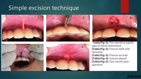Indications And Pre Prosthetic Procedures For Making Prosthesis Dr