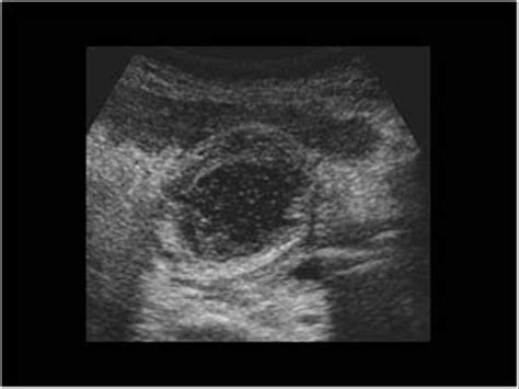 Abdomen And Retroperitoneum 12 Gallbladder And Bile Ducts Case 12