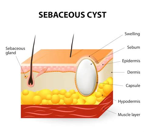 Sebaceous Cysts Symptoms Causes And Treatment
