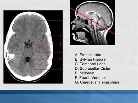 How To Read A Brain Ct Scan Moderate
