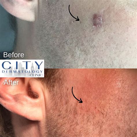Before And After Photos Cyst Removal
