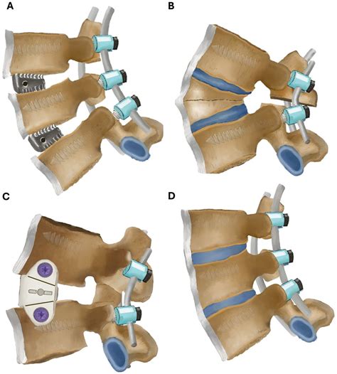 Optimizing Spinal Realignment A Comparative Analysis Of Correction And