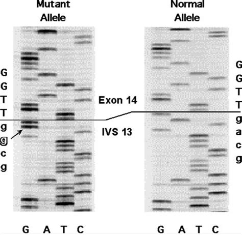 Sequence Of Normal And Mutant Genomic Dna At 1 V Intron 13 Exon 14 Download Scientific Diagram