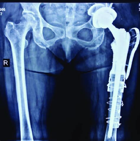 Postoperative Radiograph Demonstrated Good Restoration Of Hip Center Download Scientific