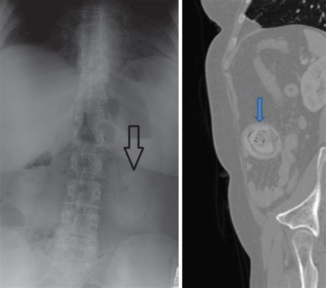 Intussusception In An Adult Consultant360