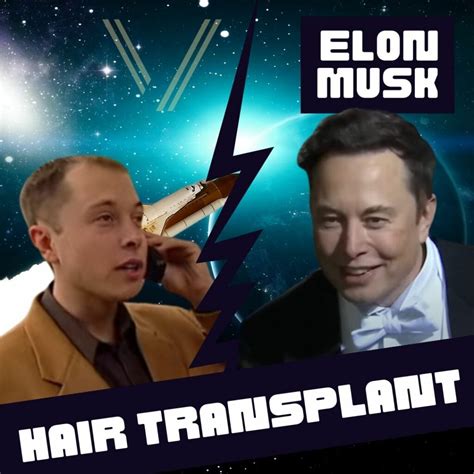 Theo Von Hair Transplant Before And After Result