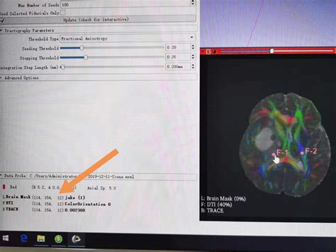 关于纤维束具体条数计算问题 问题求助 3dslicer中文论坛