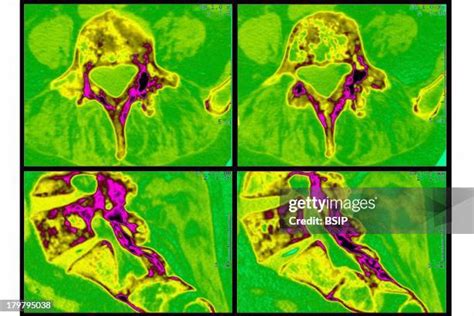 Pagets Disease Photos And Premium High Res Pictures Getty Images
