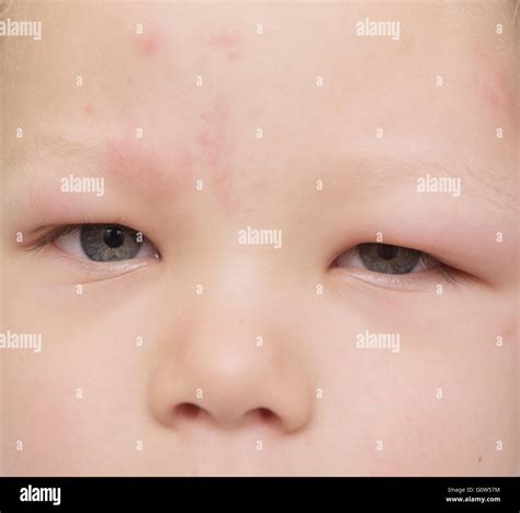 Bug Bite Swelling On Face