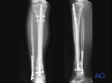 Cpt Code For Tibial Plateau Fracture At Pablo Joyce Blog