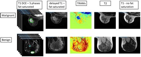 Advanced Mri Breast Lesions Collection1 Cropped The Cancer Imaging Archive Tcia