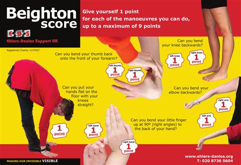 Beighton Score Ehlers Danlos Syndrome Ehlers Danlos Syndrome