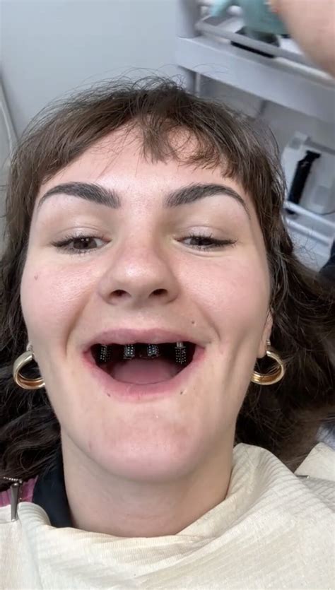 Woman Splashes £31000 On New Teeth To Avoid Taking Out Dentures In Front Of Lovers Whats The Jam