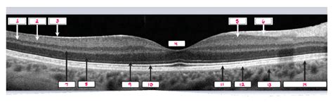 Posterior Segment Pathology Oct Retinal Layers Diagram Quizlet