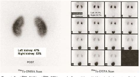 Pdf] Comparison Of Split Renal Function Measured By 99m 53 Off