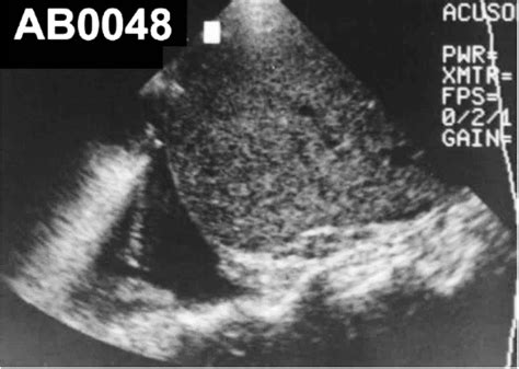 Pocus Lung Exam Fluid Overload And Venous Congestion Assessment Sfjo