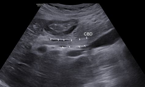 Biliary Ascariasis Shivi X Ray And Ultrasound Centre Shivi Imaging
