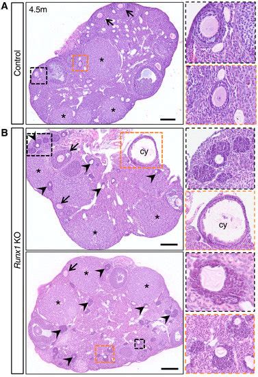 Loss Of Runx1 Induces Granulosa Cell Defects And Development Of Ovarian